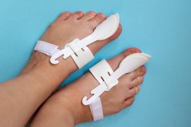 How to Correct a Hammertoe Without Surgery