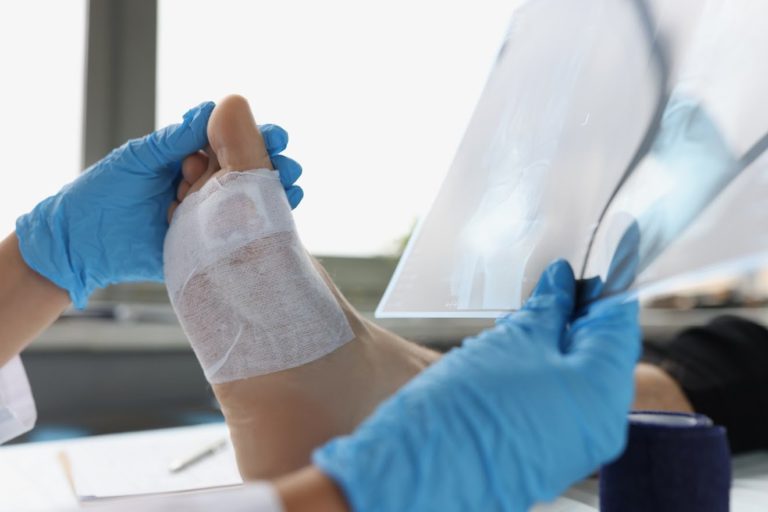 Floating Toe After Hammertoe Surgery