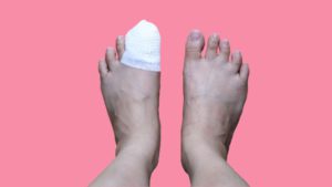 Hammertoe Surgery Before and After