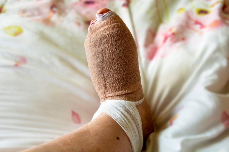 Hammertoe Surgery Recovery