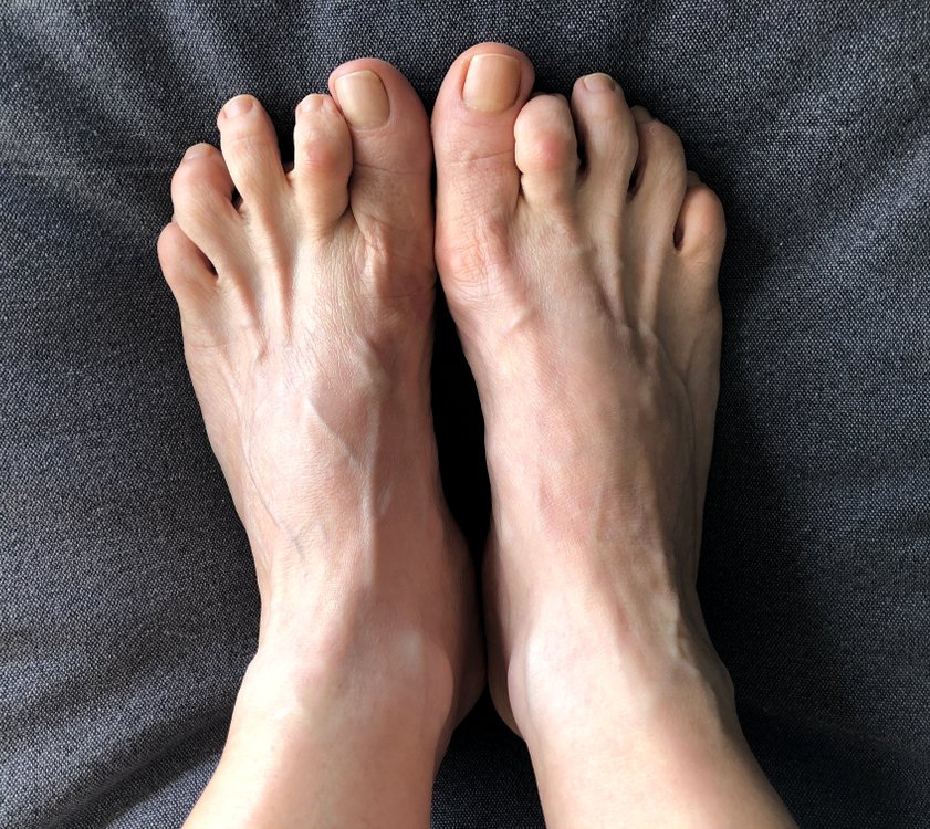 Minimally Invasive Hammertoe Surgery