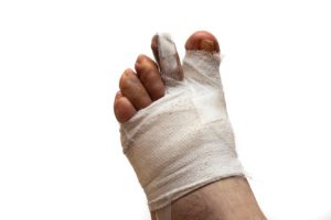 Pin Removal After Hammertoe Surgery - Luxe Foot Surgery