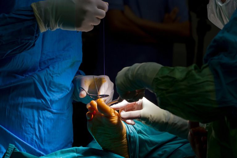 Toe Shortening Surgery