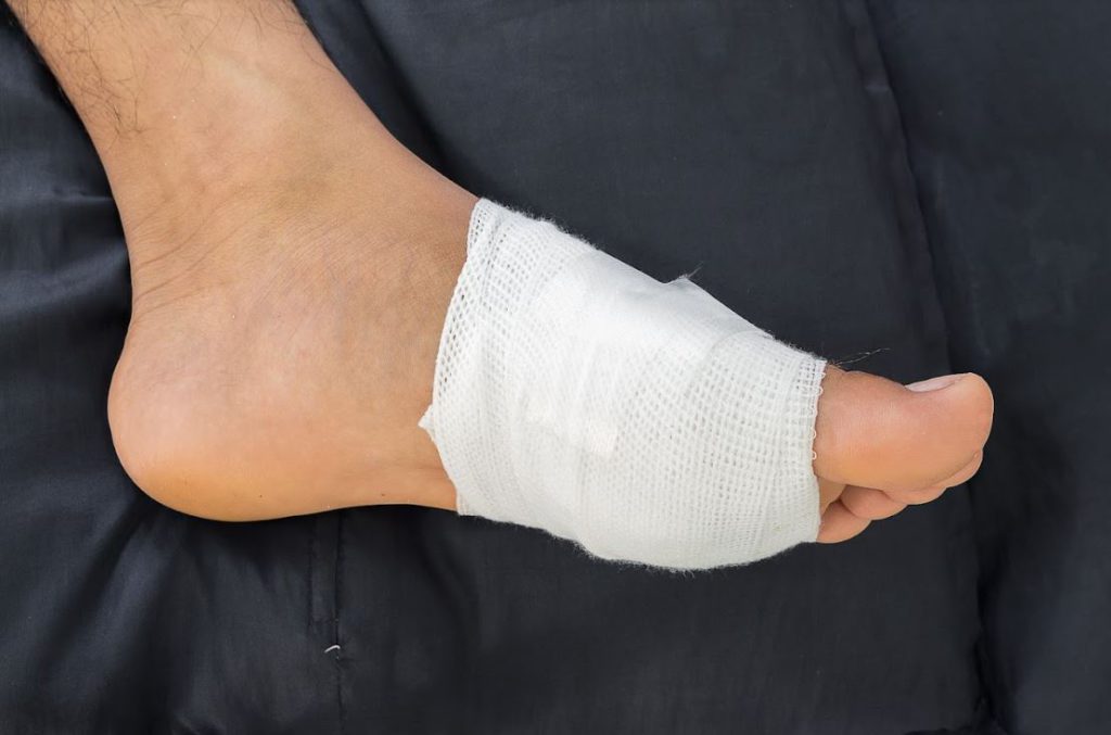 Once Stitches Are Removed After Bunion Surgery, Do I Keep It Covered