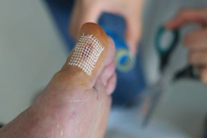Pain After Corn Removal Surgery