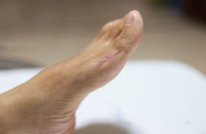 Once Stitches Are Removed After Bunion Surgery, Do I Keep It Covered