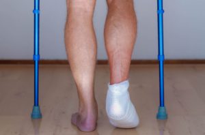 Weight Bearing After Bunion Surgery