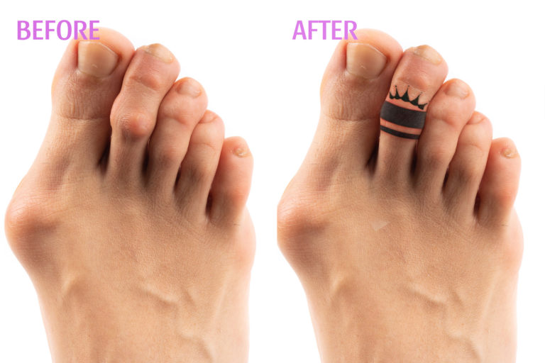 Toe tattoos to cover corns