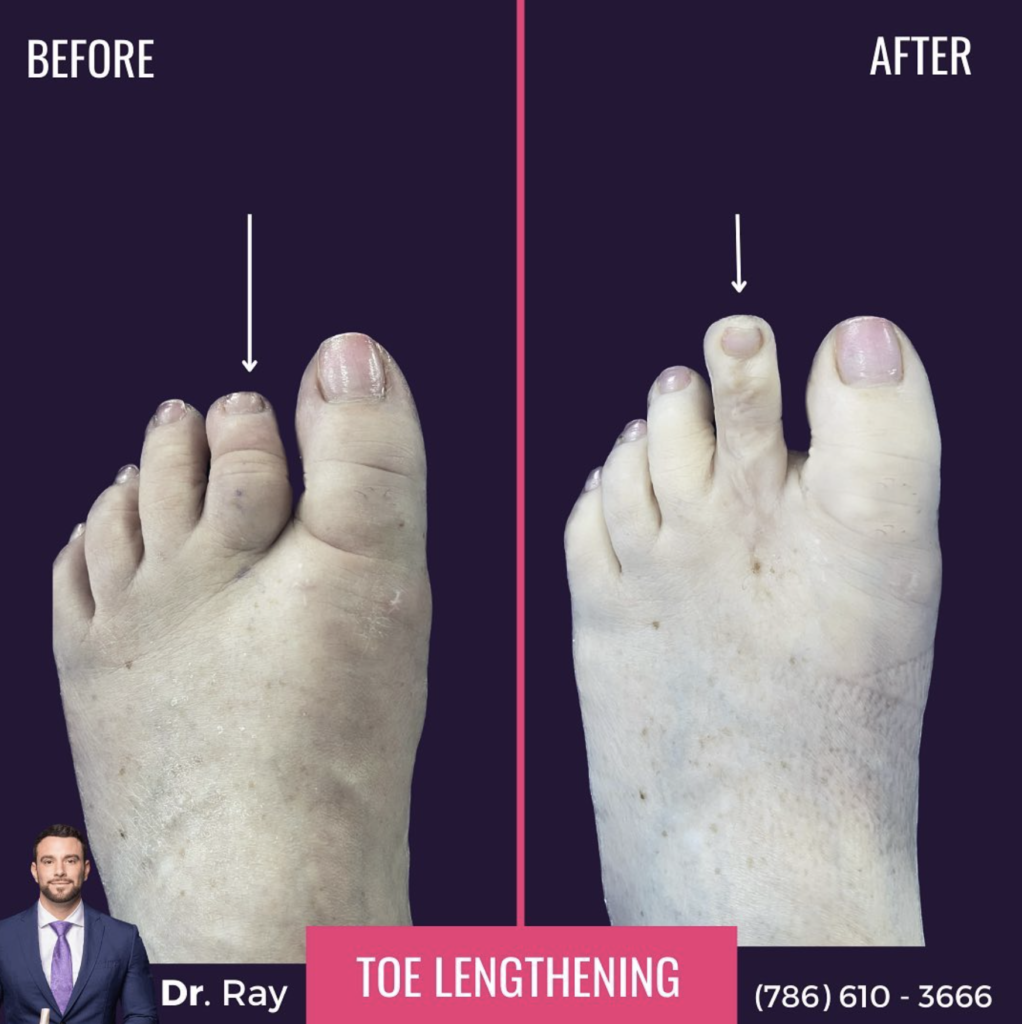Toe Lengthening Surgery Miami
