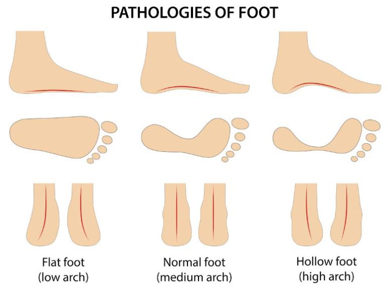 Flat Feet vs High Arch
