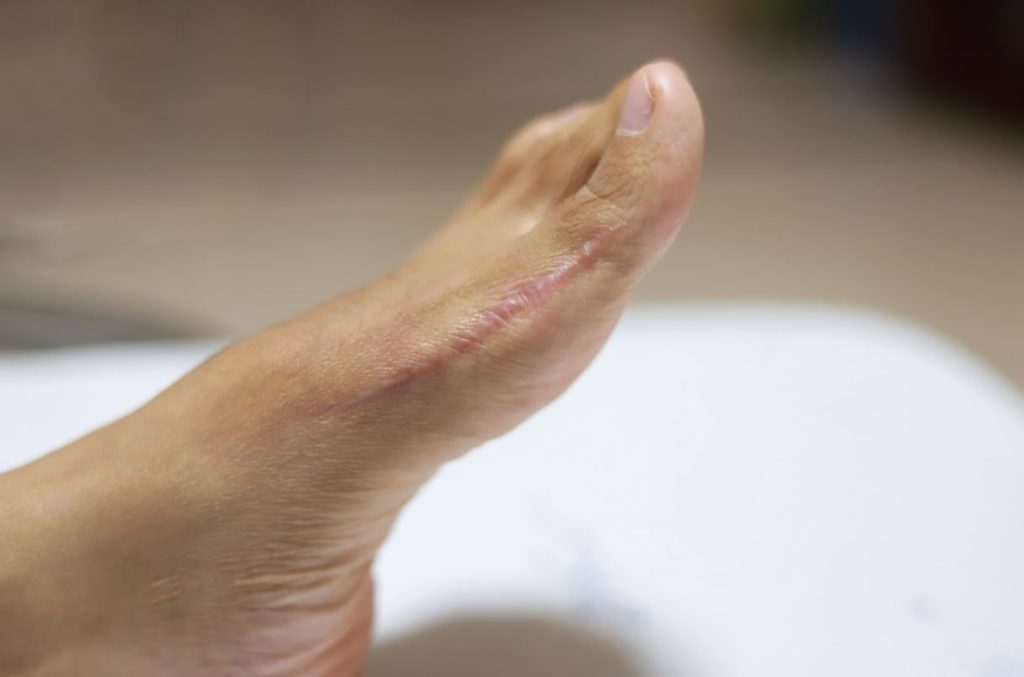 Tailors Bunion Surgery Scar