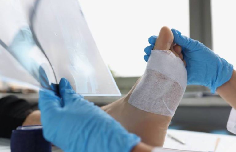 Bunion Surgery in Miami from $2500 at Luxe Foot Surgery