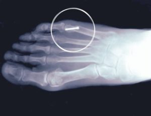 Tailor Bunion Surgery With Screws