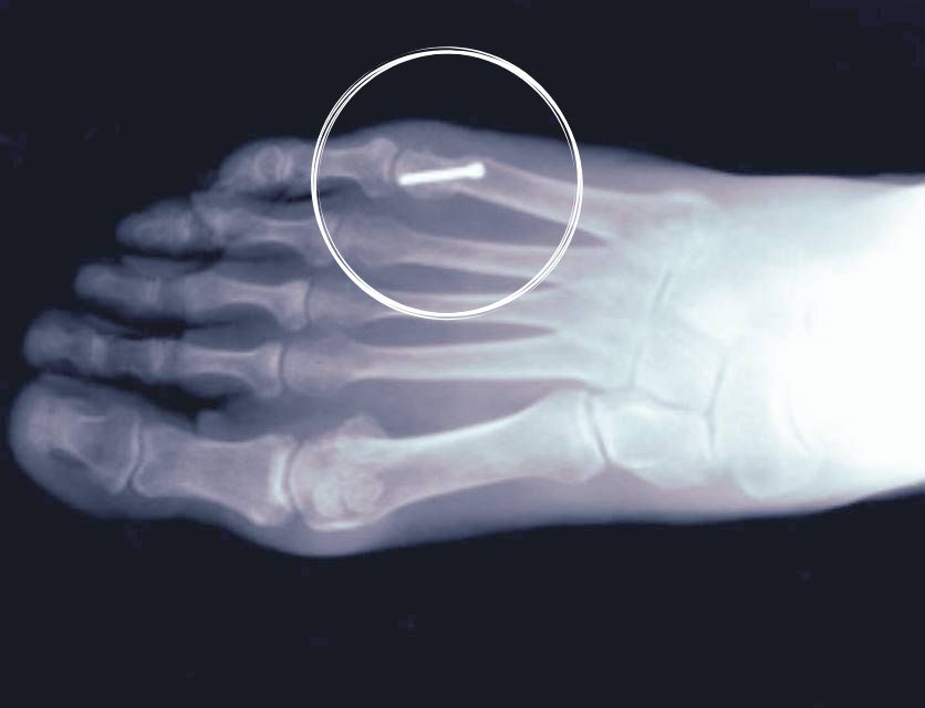 Tailors Bunion Xray Tailors Bunion Xray