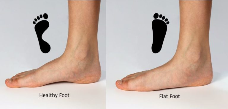 Flat Feet Surgery Miami - Relief from Pain and Discomfort