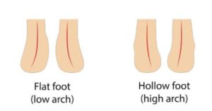 Flat Feet vs High Arch