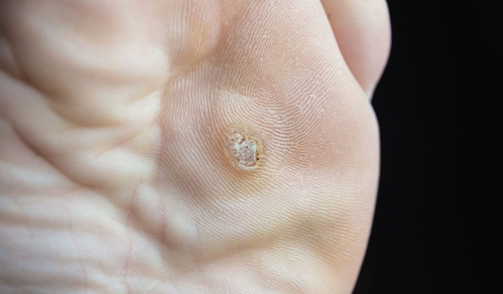 How to Treat a Painful Callus on Foot