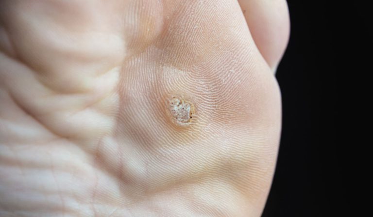 How to Treat a Painful Callus on Foot