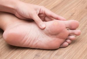 The Anatomy of a Corn on the Foot: Understanding How Corns Form and Develop