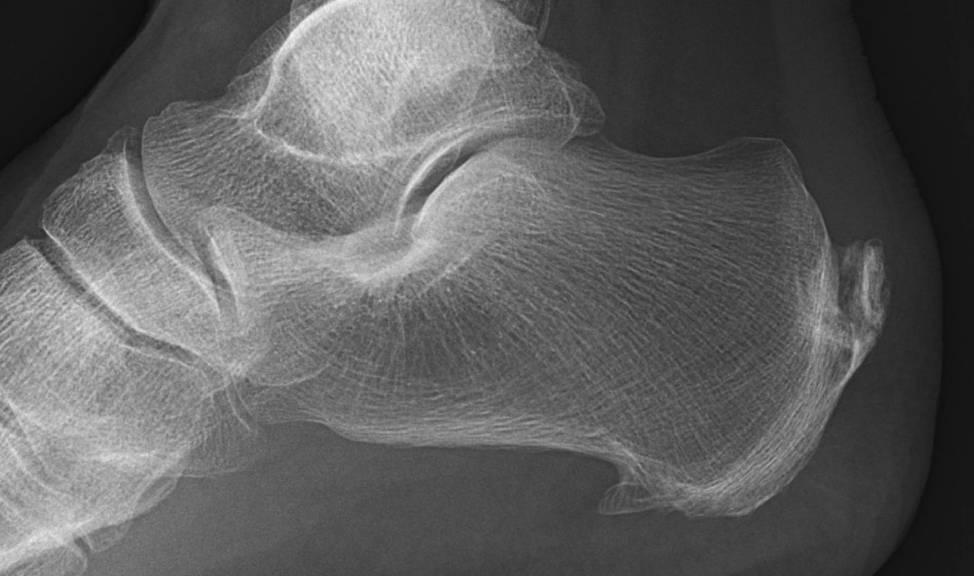 Heel Spur Surgery in Miami | Starting at $4000 | Luxe Foot Surgery