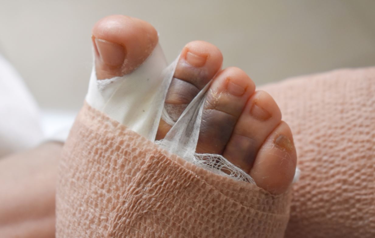 Luxe Foot Surgery | Hallux Rigidus Surgery Starting at $5000