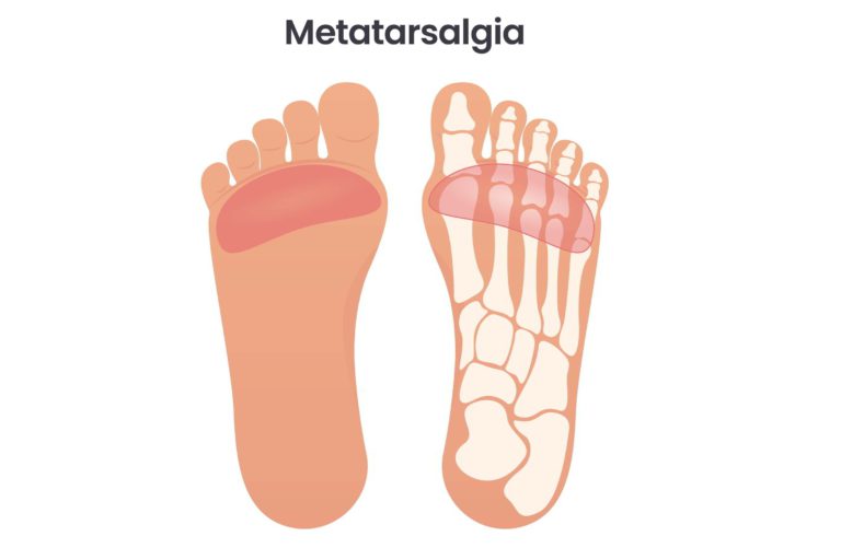 Metatarsalgia Surgery in Miami: Expert Treatment for Foot Pain