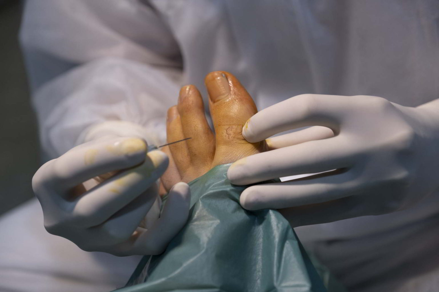 Metatarsalgia Surgery in Miami: Expert Treatment for Foot Pain