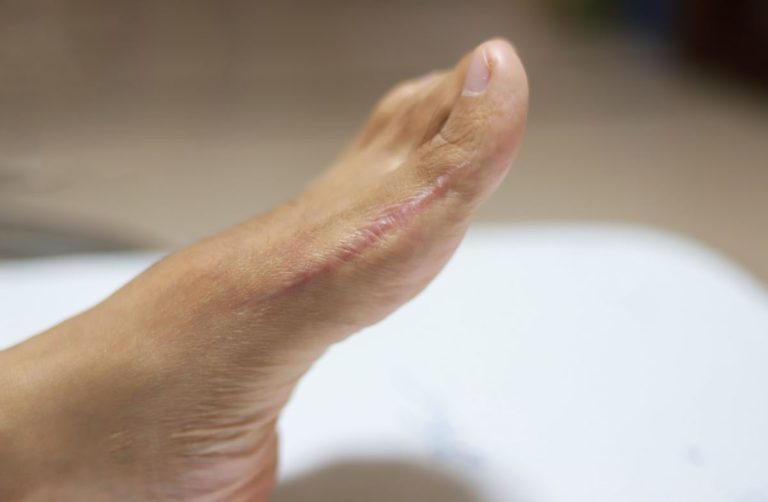 Toe Extensor Tendon Lengthening CPT