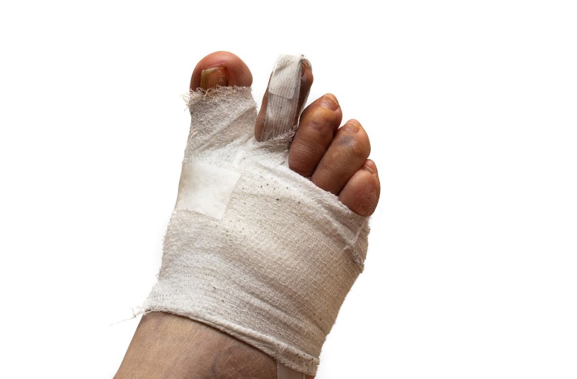 Toe Surgery for Hammertoe Correction