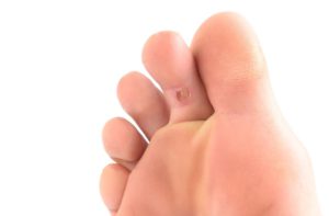 How to Remove Soft Corns?