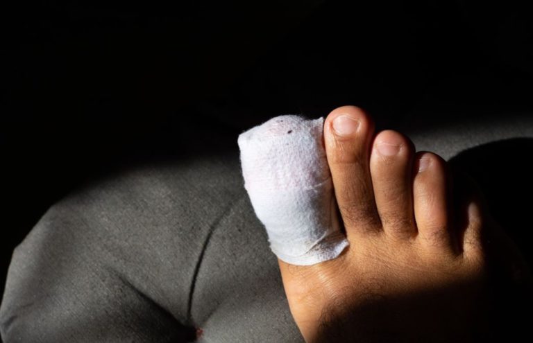 How to Treat a Corn on the Side of my Foot?