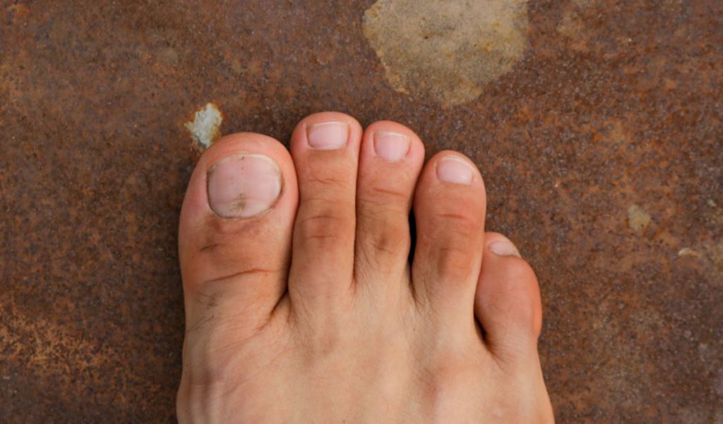 Toe Shortening Surgery