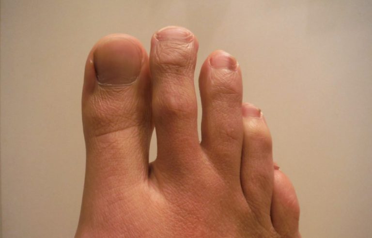 Inside of a Corn on Foot: Understanding the Anatomy of a Corn and How ...