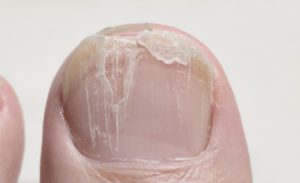 All There Is to Know About Toenails Growing in Layers