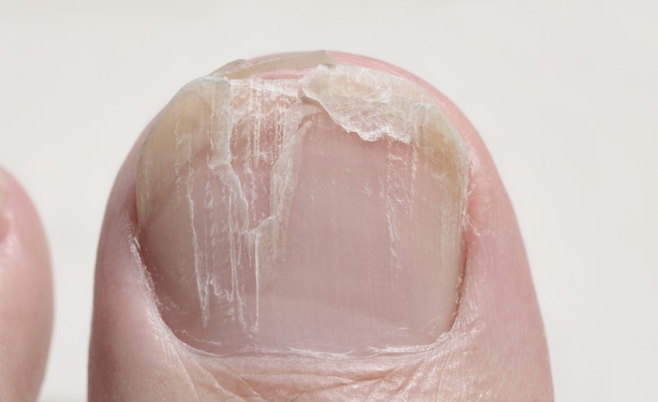 All There Is To Know About Toenails Growing In Layers