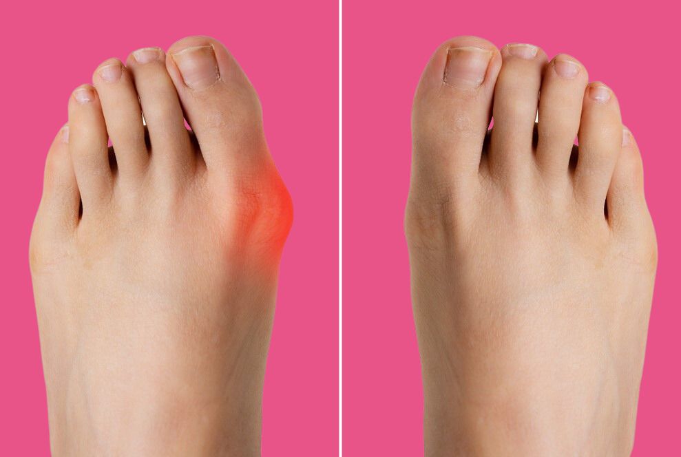 Bunion Surgery in Miami from $2500 at Luxe Foot Surgery