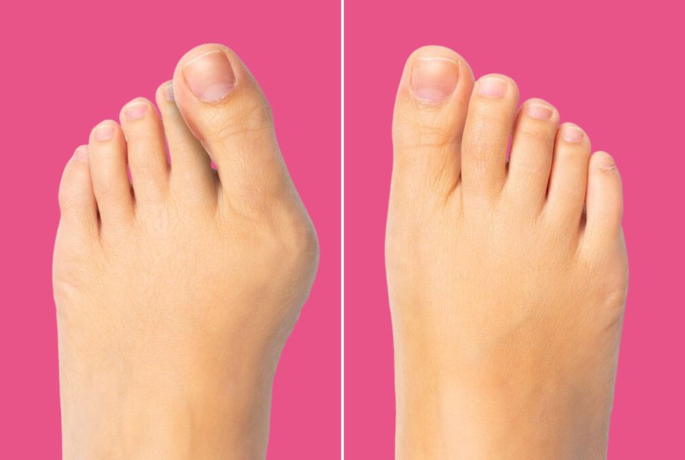 Bunion Surgery in Miami from $2500 at Luxe Foot Surgery