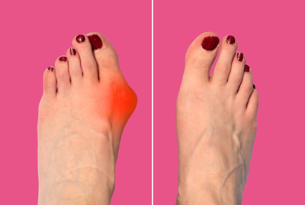 Bunion Surgery in Miami from $2500 at Luxe Foot Surgery