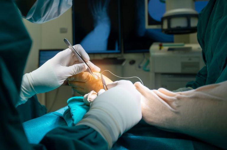 Bunion Surgery in Miami from $2500 at Luxe Foot Surgery