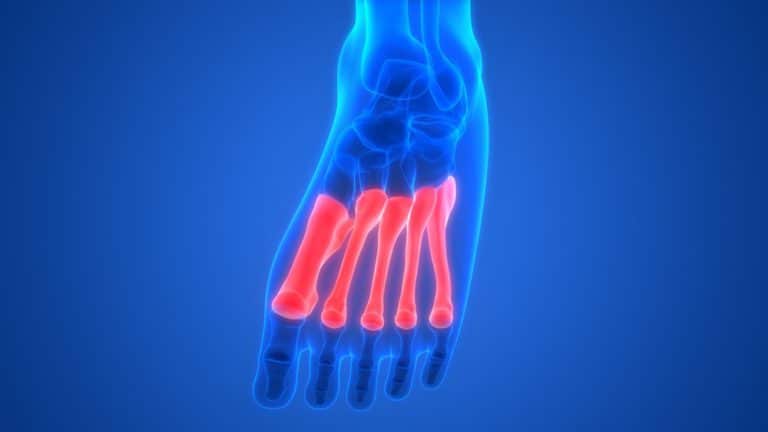 2nd Metatarsal Surgery Recovery Time: Regain Mobility Faster