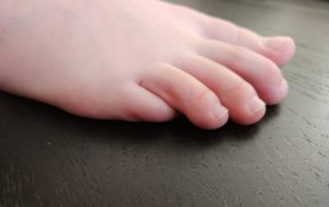 Pinky Toe Underlapping: Causes, Effects, and Treatment Options