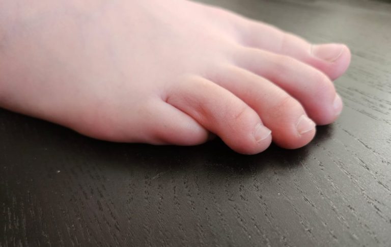 Pinky Toe Underlapping: Causes, Effects, and Treatment Options
