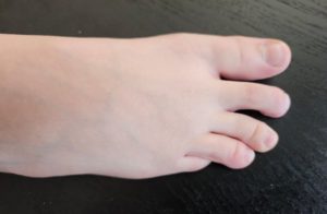 Pinky Toe Underlapping: Causes, Effects, and Treatment Options