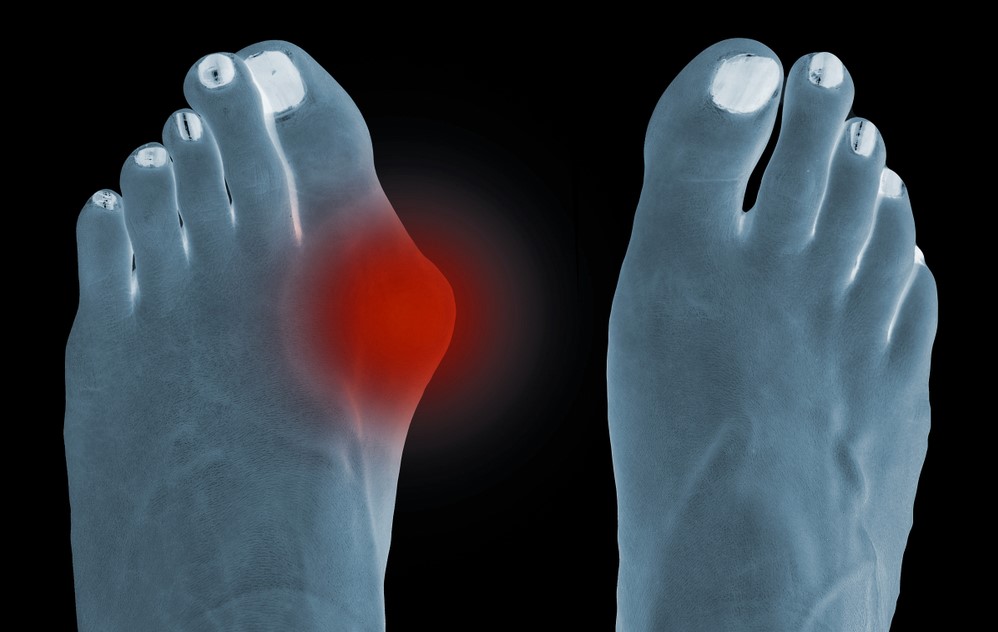 Bunion Surgery in Miami from $2500 at Luxe Foot Surgery