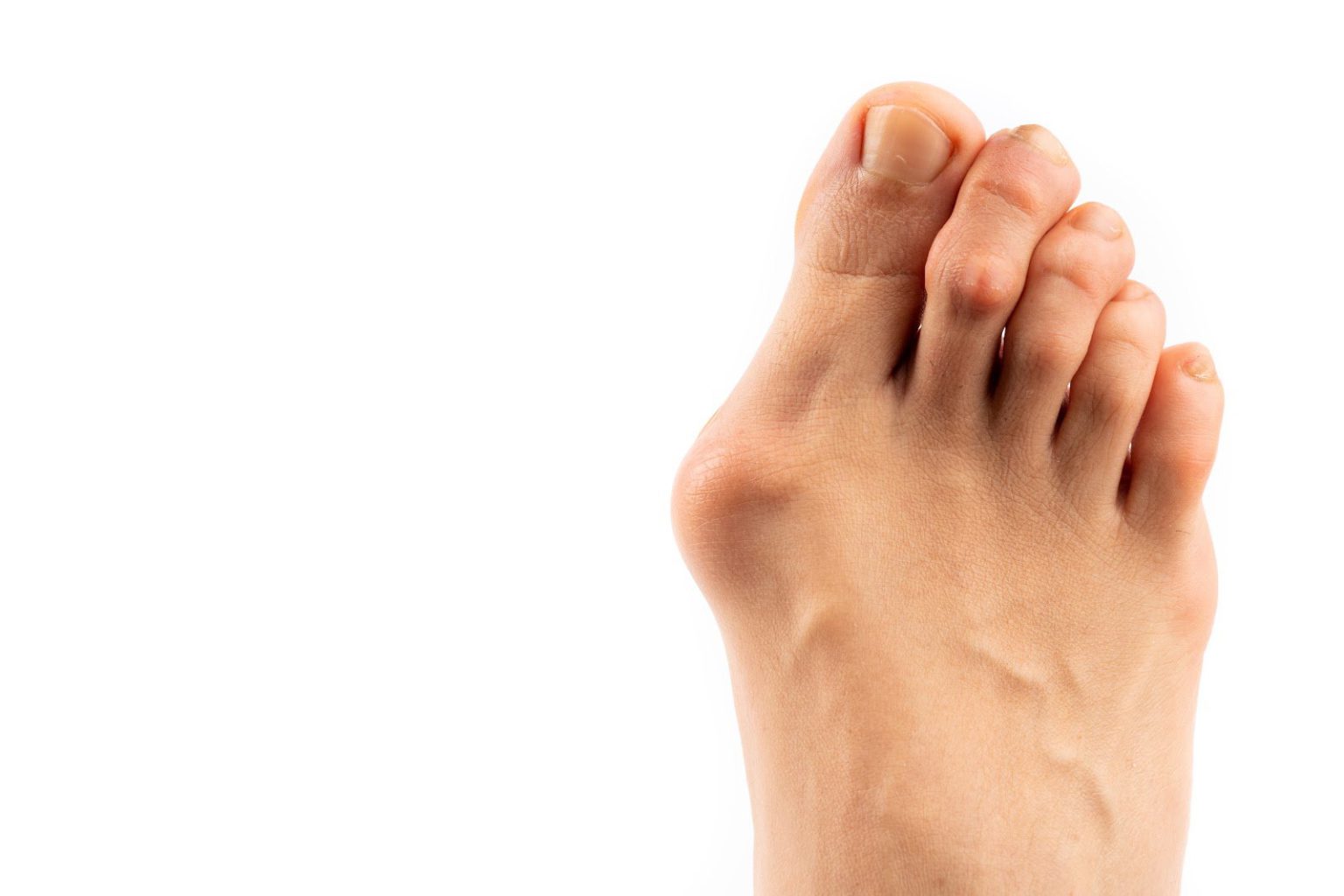 Bone Spur or Bunion? Decoding Your Foot Pain