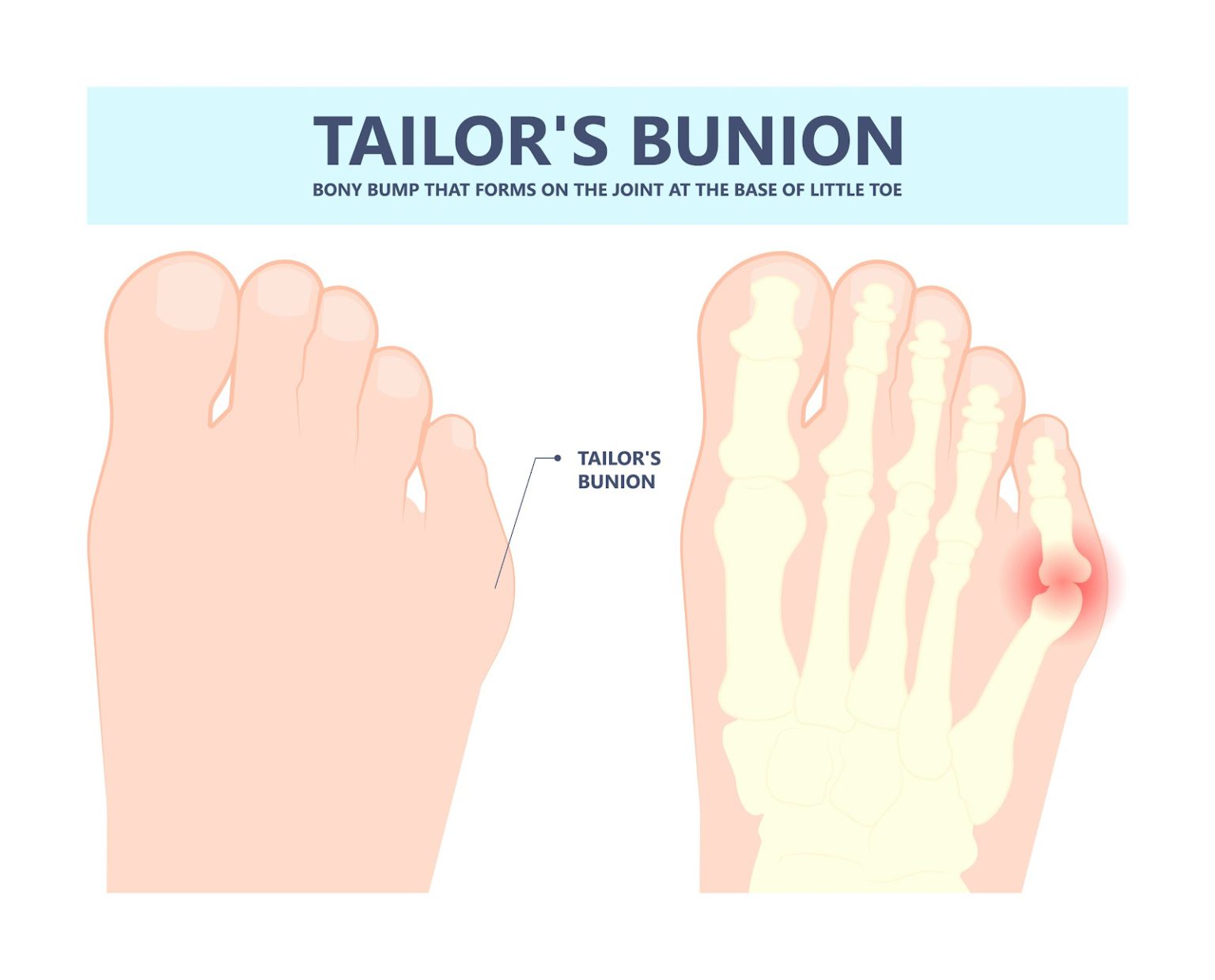 Bunion on the Little Toe: Causes, Symptoms, and Treatment Options ...