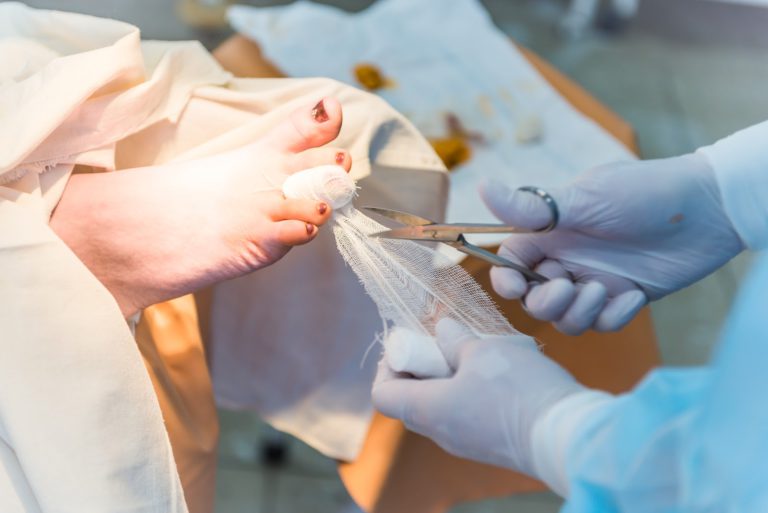 Floppy Toe After Hammertoe Surgery: Causes & Solutions