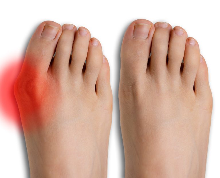 Bunion Surgery in Miami from $2500 at Luxe Foot Surgery