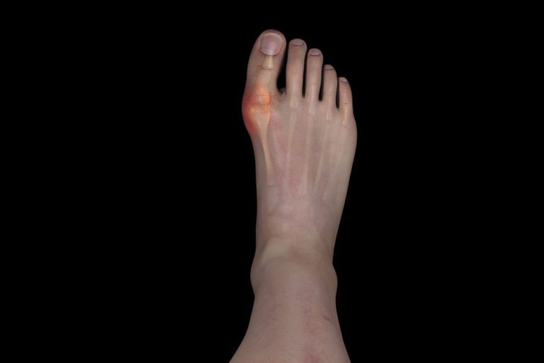 Bruised Bunion From Running: Solutions & Relief