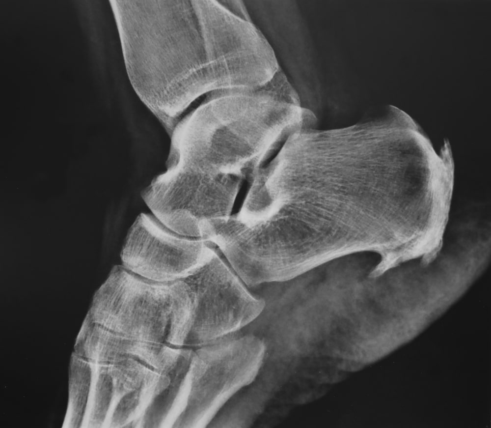 Tailor Bunion Surgery Miami: Expert Care for Foot Pain Relief